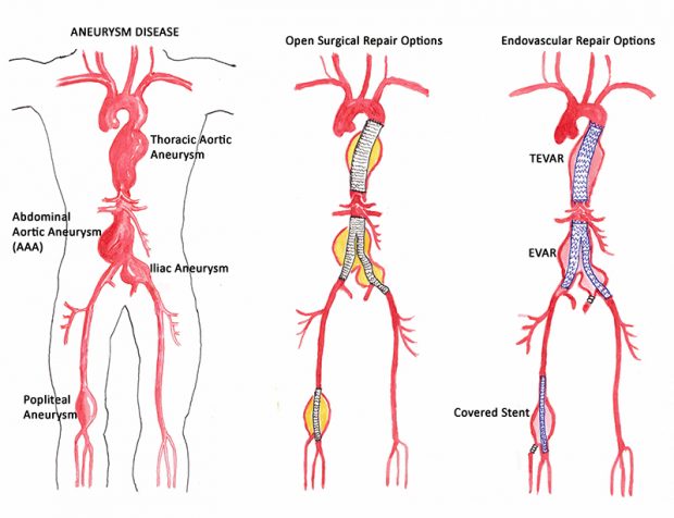 Vascular Diseases – AVE Clinics